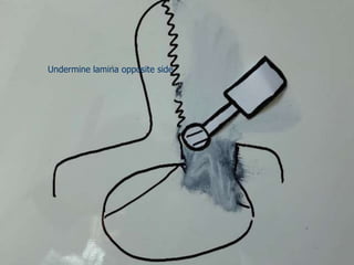 Lumbar Spinal Stenosis ULBD technique | PPTX