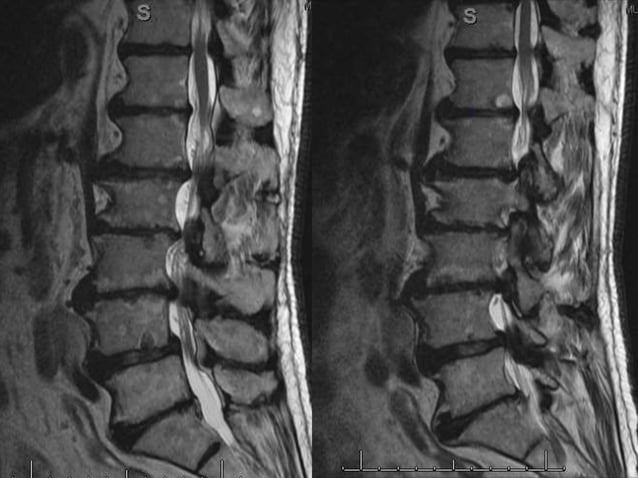 Lumbar Spinal Stenosis ULBD technique | PPTX
