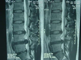 Lumbar Spinal Stenosis ULBD technique | PPTX