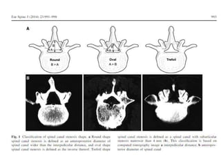 Lumbar Spinal Stenosis ULBD technique | PPTX