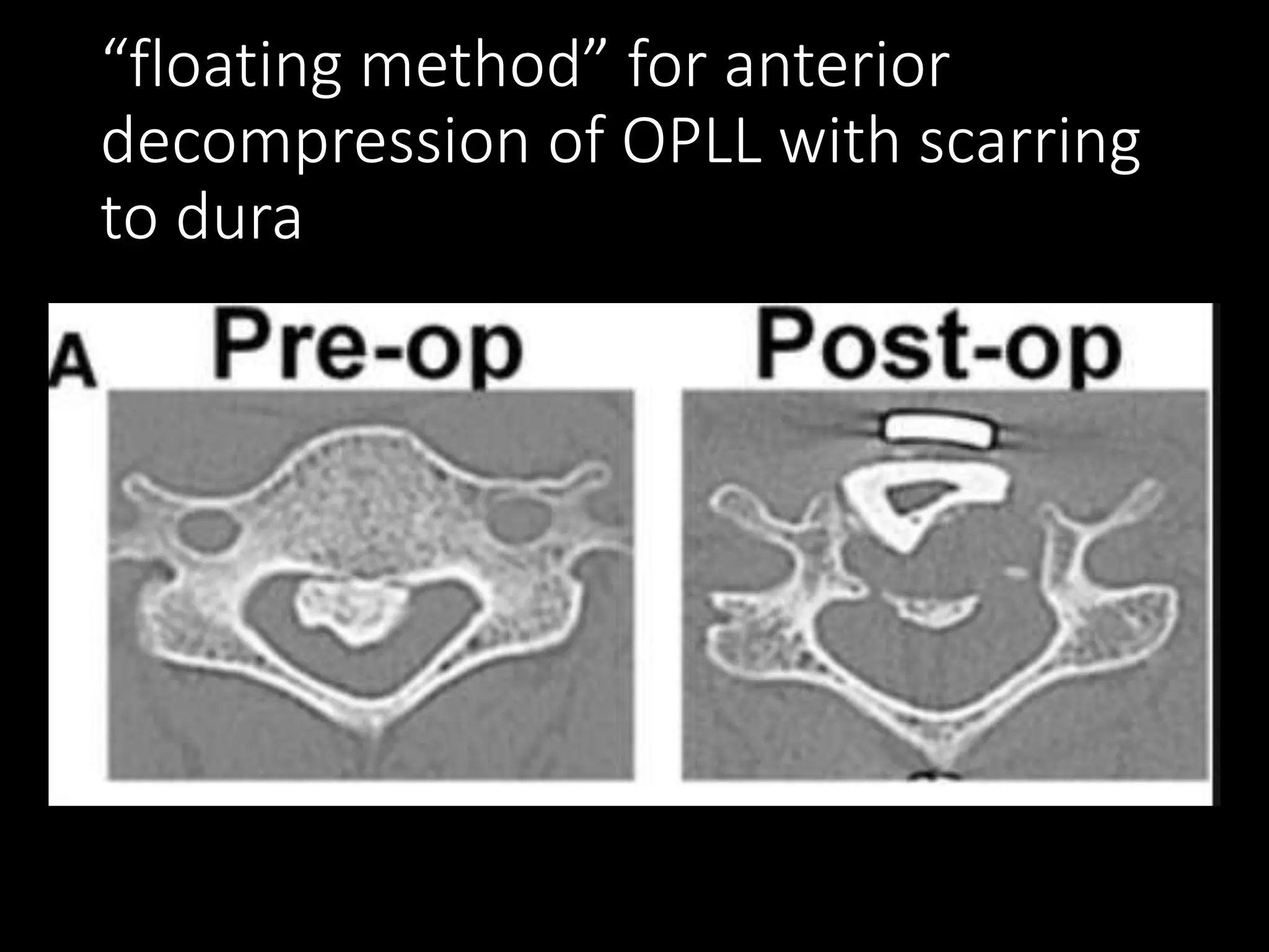 Spine Lecture tandem spinal stenosis 2019 | PPTX