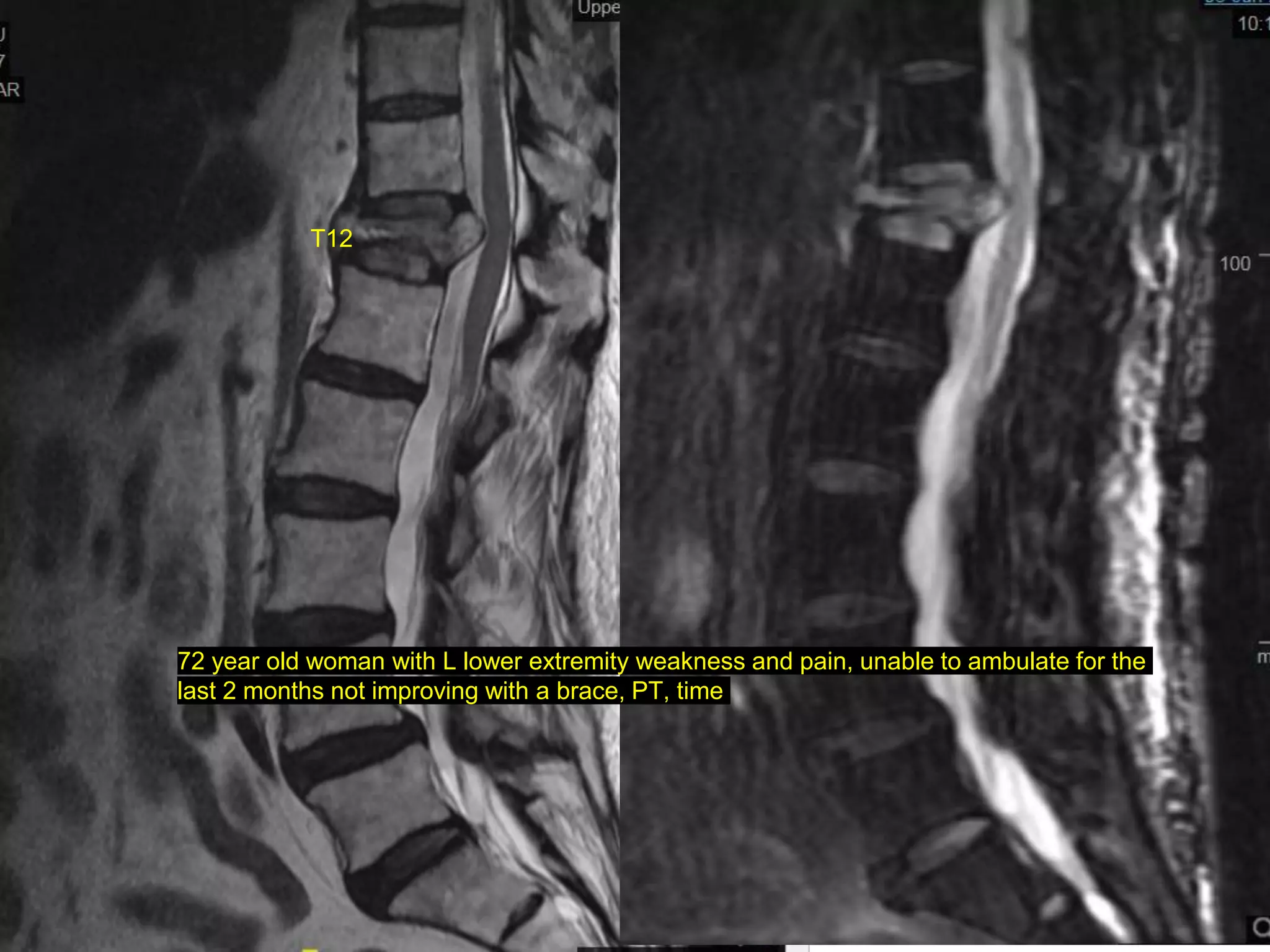 spine conference: thoracic disc herniations | PPT