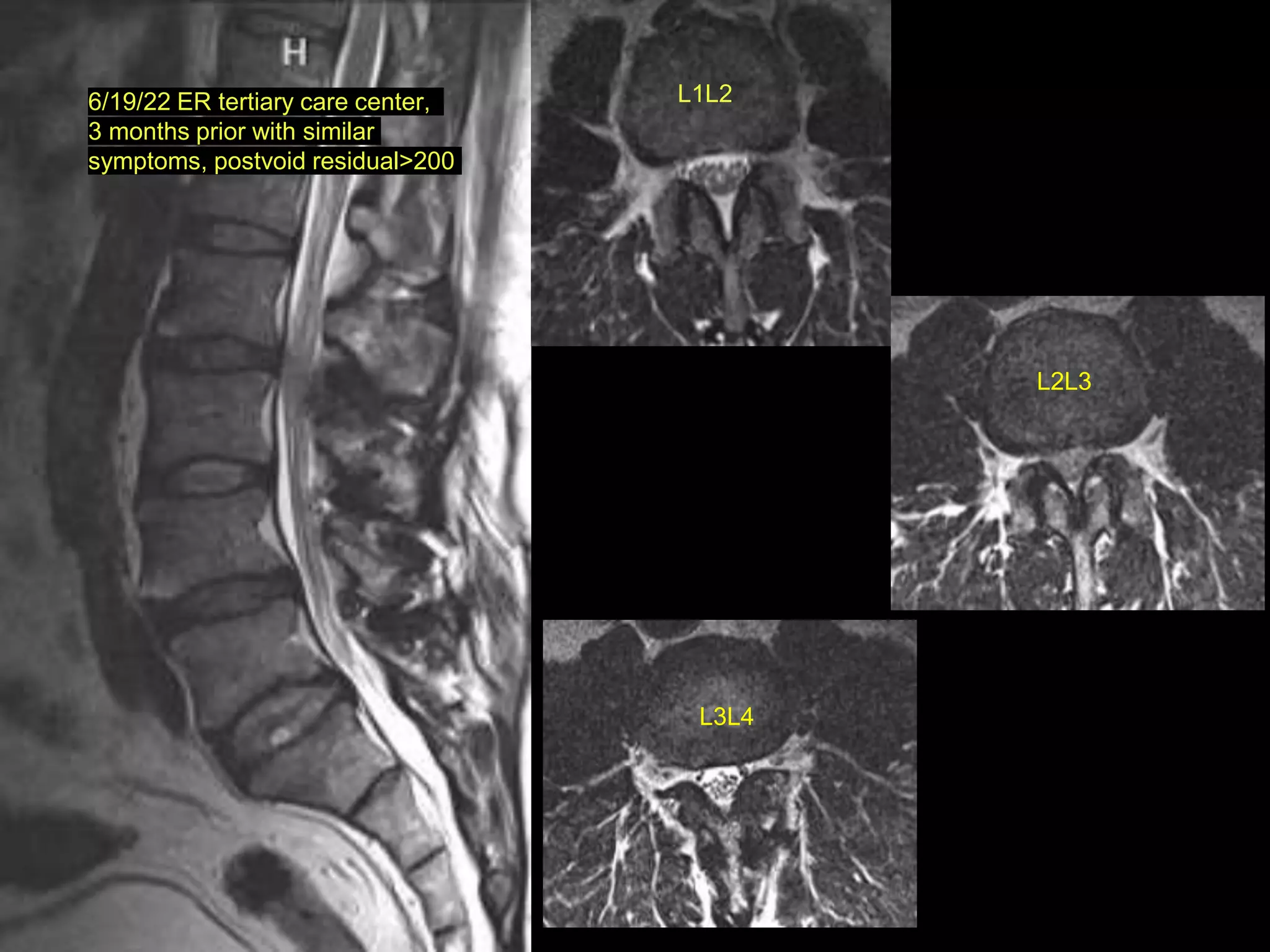 spine conference: thoracic disc herniations | PPT