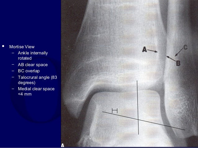 Lecture trauma ankle_tendon