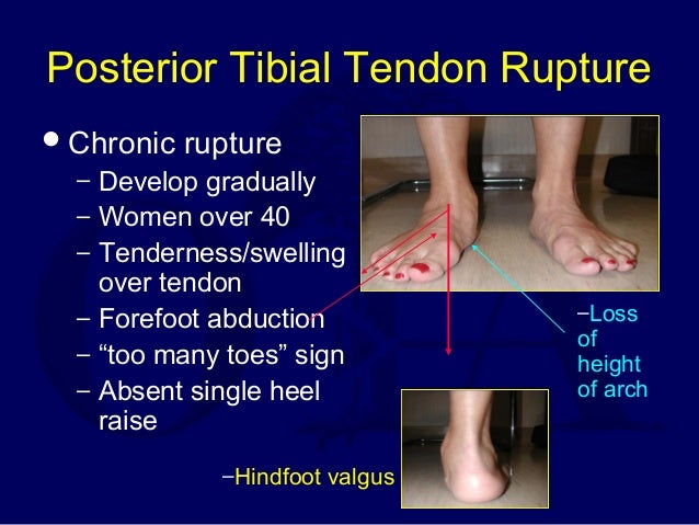 Lecture trauma ankle_tendon