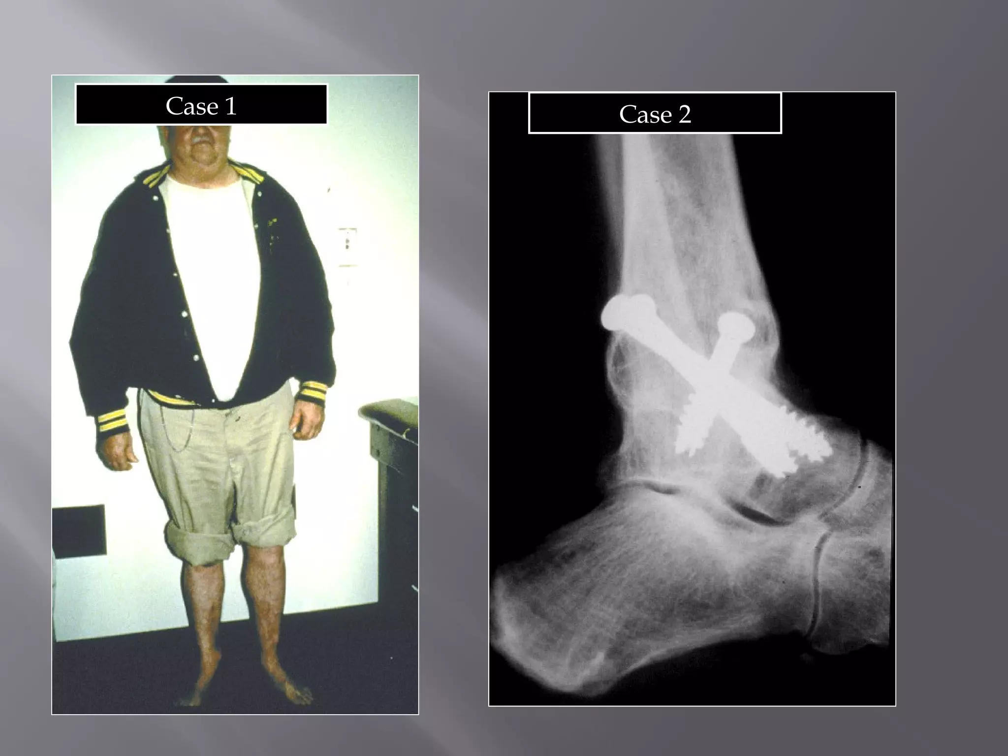 Lecture ucmc pilon plafond fracture distal tibia | PPT | Death, Injury ...