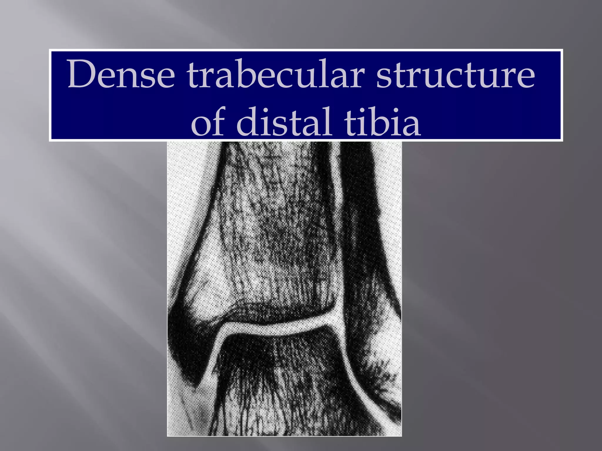 Lecture ucmc pilon plafond fracture distal tibia | PPT | Death, Injury ...