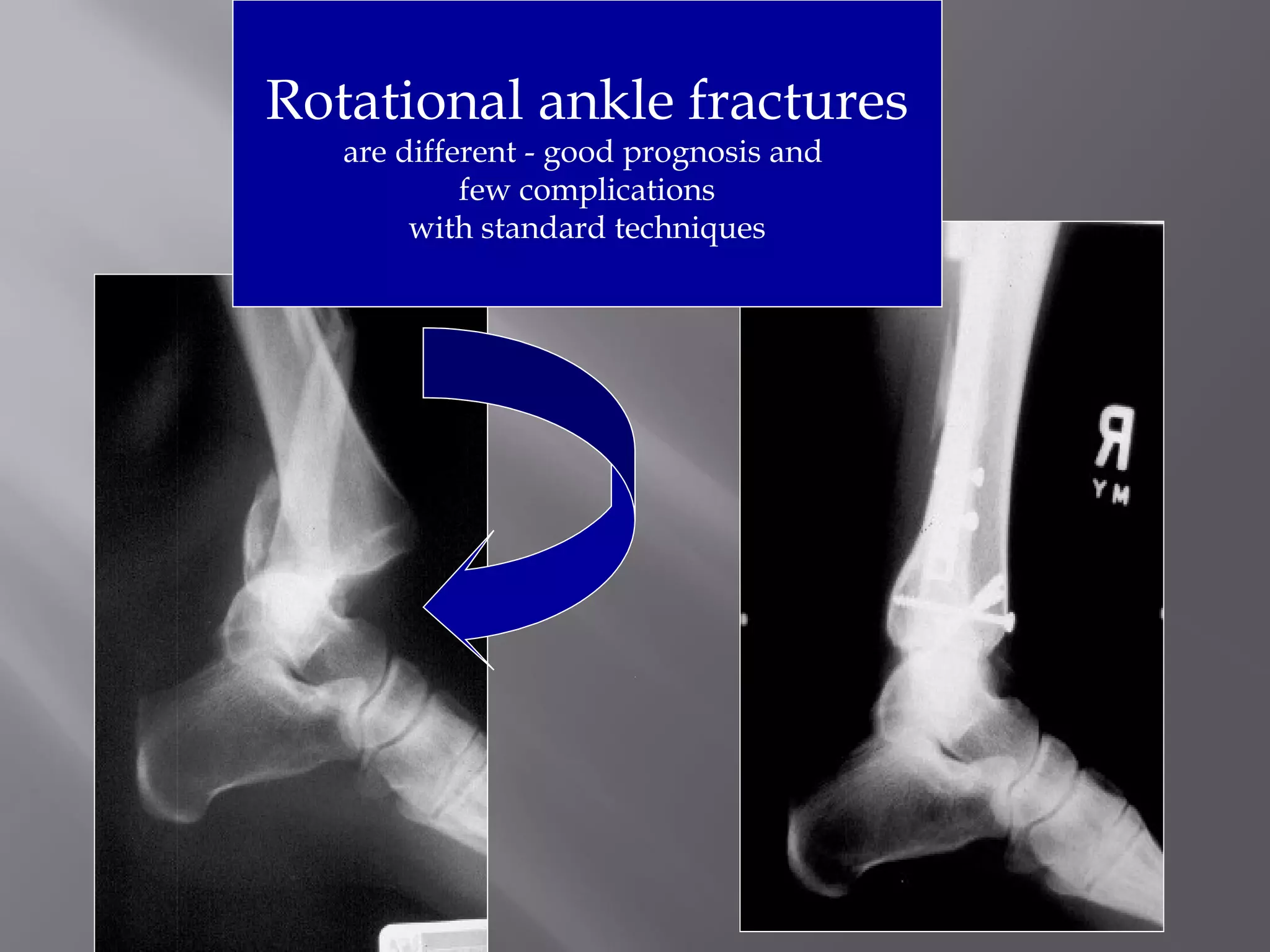 Lecture ucmc pilon plafond fracture distal tibia | PPT