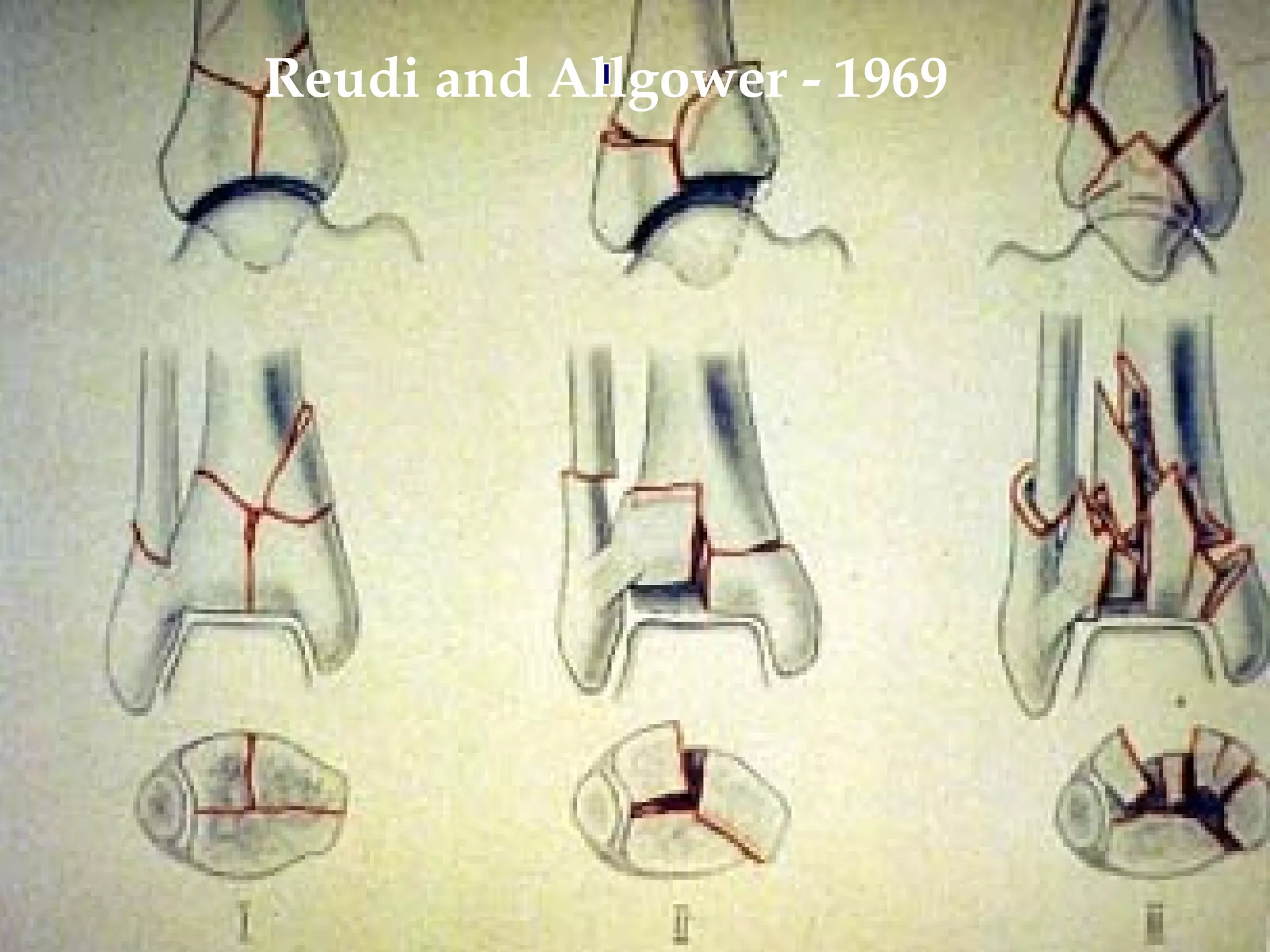Lecture ucmc pilon plafond fracture distal tibia | PPT | Death, Injury ...