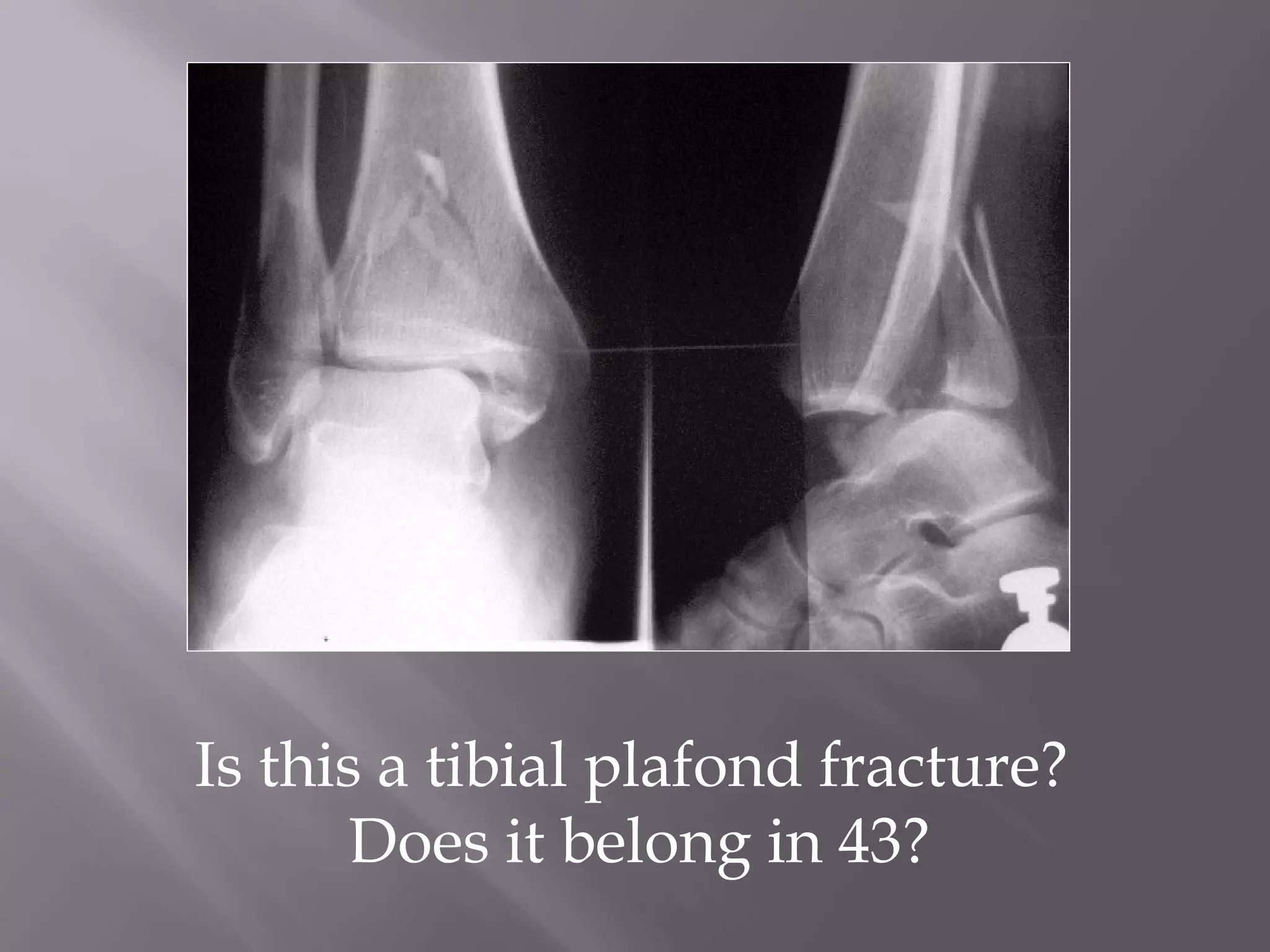 Lecture ucmc pilon plafond fracture distal tibia | PPT | Death, Injury ...