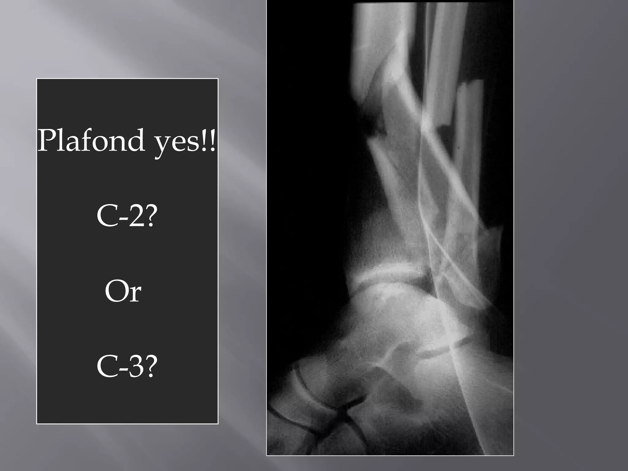Lecture ucmc pilon plafond fracture distal tibia | PPT | Death, Injury ...