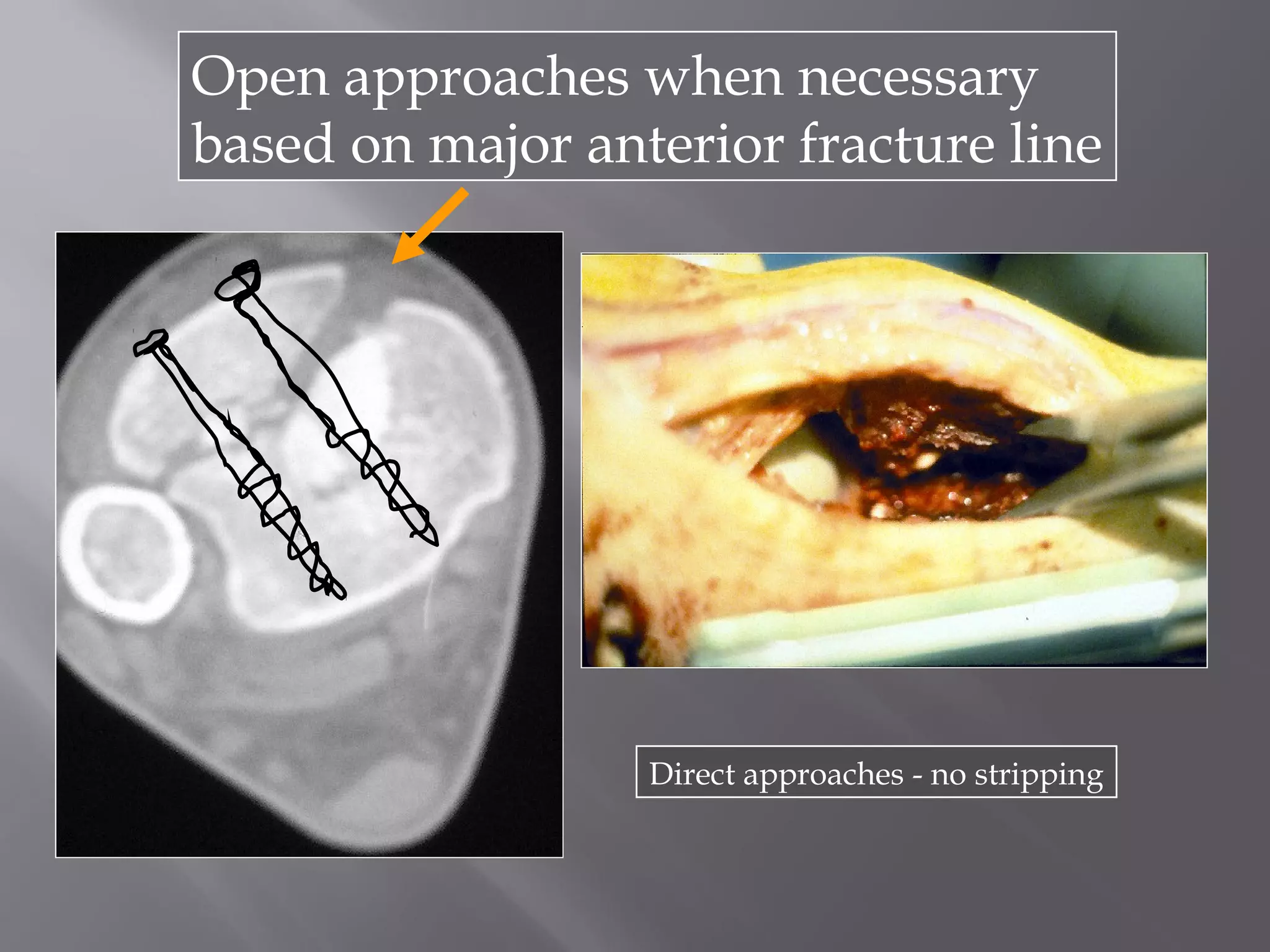 Lecture ucmc pilon plafond fracture distal tibia | PPT | Death, Injury ...