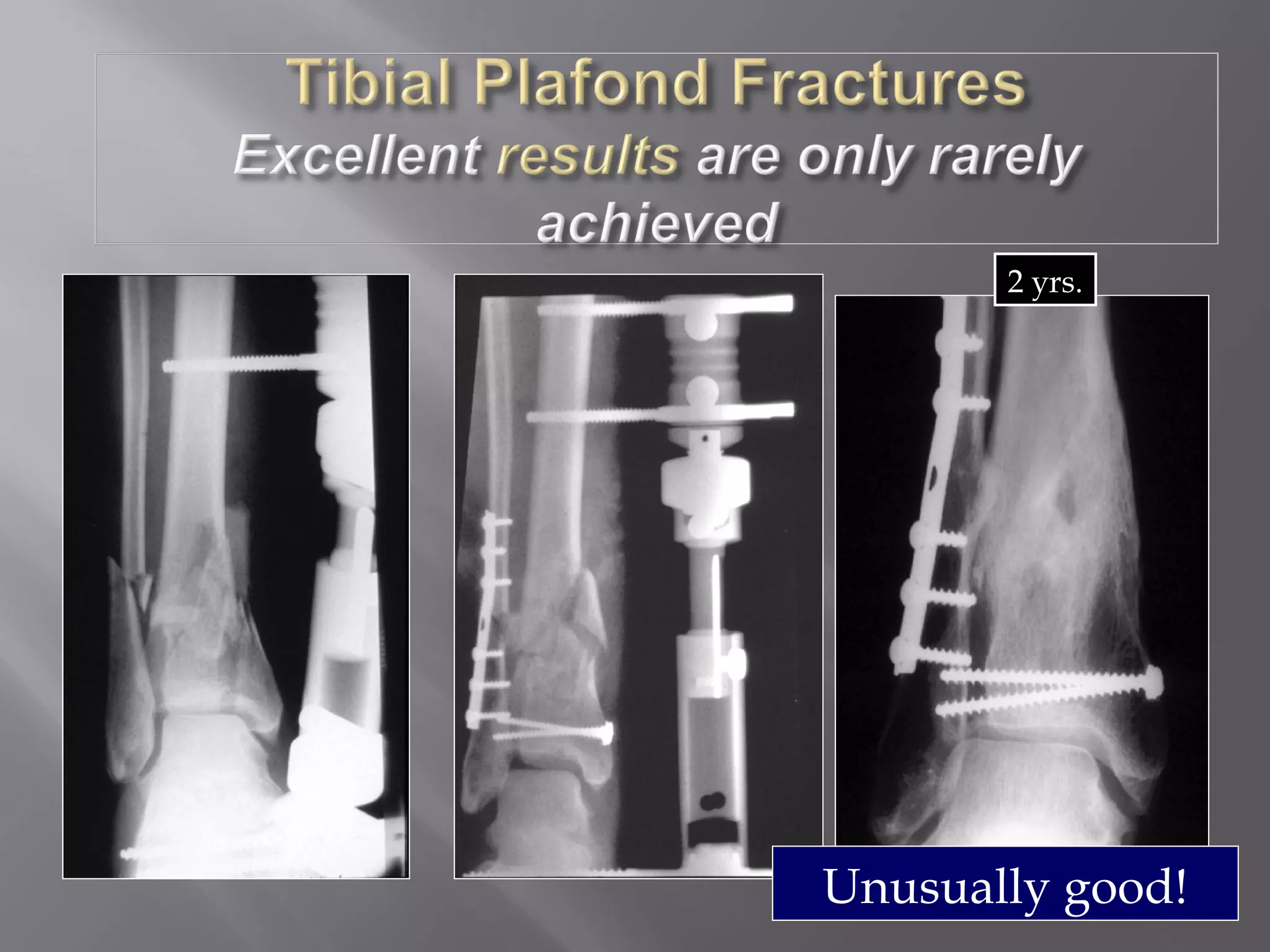 Lecture ucmc pilon plafond fracture distal tibia | PPT | Death, Injury ...