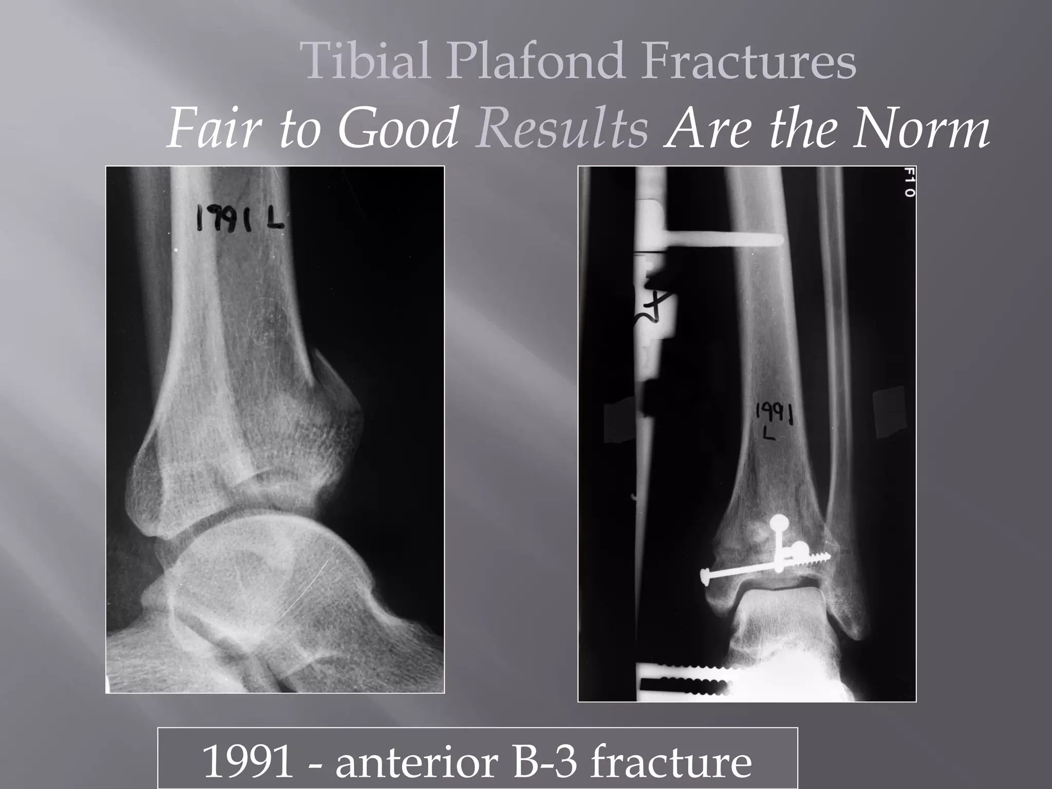 Lecture ucmc pilon plafond fracture distal tibia | PPT | Death, Injury ...