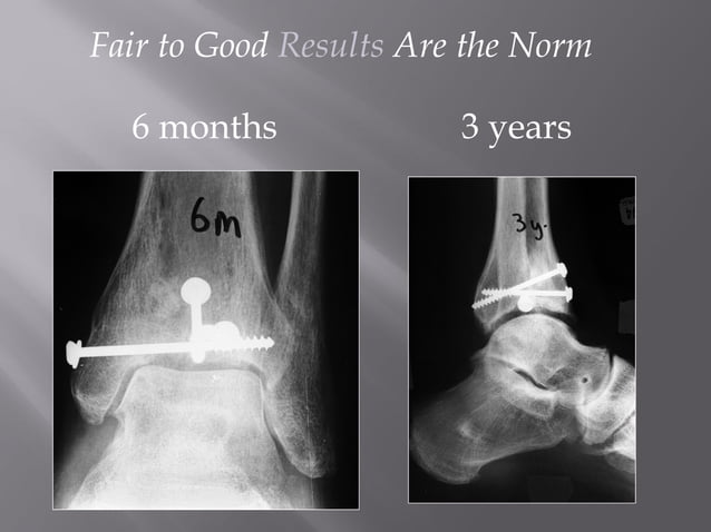 Lecture ucmc pilon plafond fracture distal tibia | PPT | Death, Injury ...