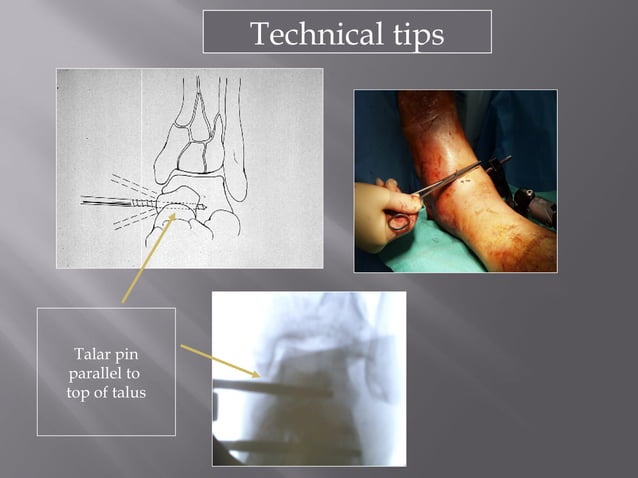 Lecture ucmc pilon plafond fracture distal tibia | PPT | Death, Injury ...
