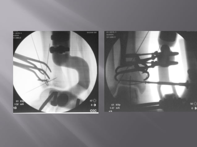 Lecture ucmc pilon plafond fracture distal tibia | PPT | Death, Injury ...