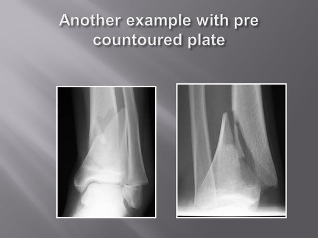 Lecture ucmc pilon plafond fracture distal tibia