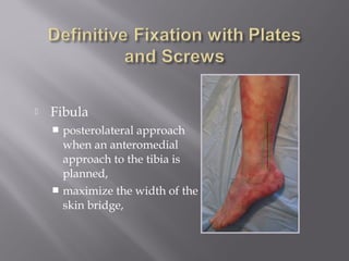 Lecture ucmc pilon plafond fracture distal tibia | PPT