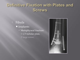 Lecture ucmc pilon plafond fracture distal tibia | PPT