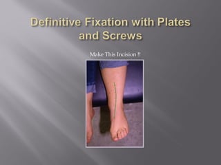 Lecture ucmc pilon plafond fracture distal tibia | PPT