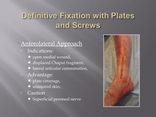 Lecture ucmc pilon plafond fracture distal tibia | PPT
