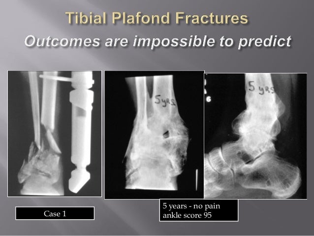 Plafond Vs Pilon Fracture