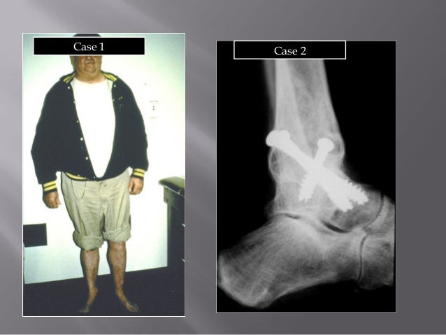 Lecture ucmc pilon plafond fracture distal tibia