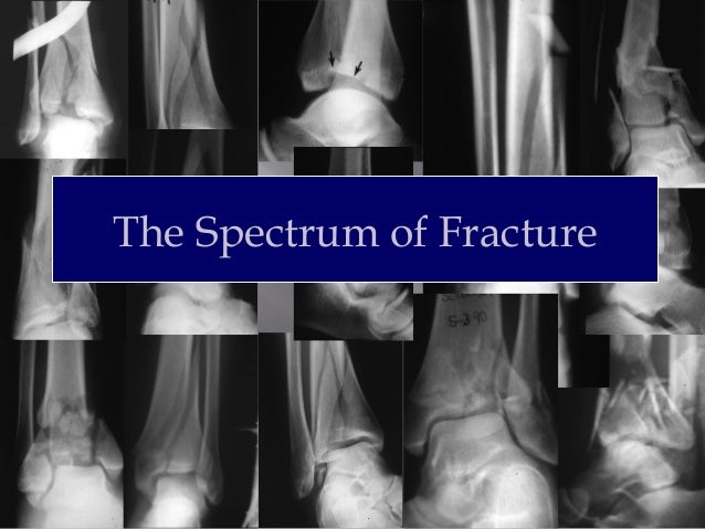 Lecture ucmc pilon plafond fracture distal tibia