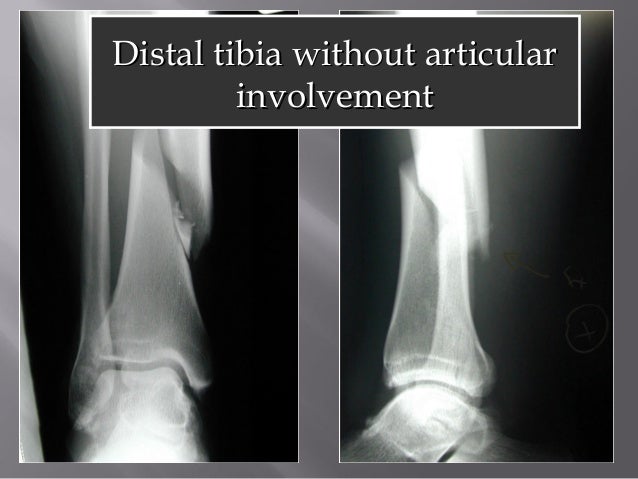 Lecture ucmc pilon plafond fracture distal tibia