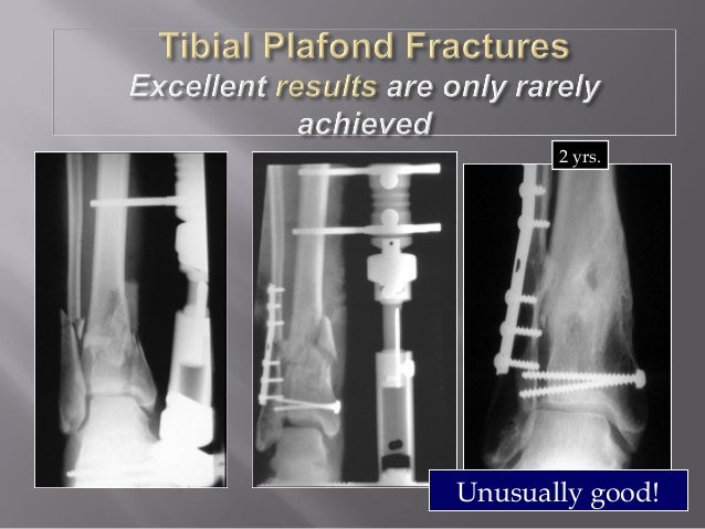 Lecture ucmc pilon plafond fracture distal tibia