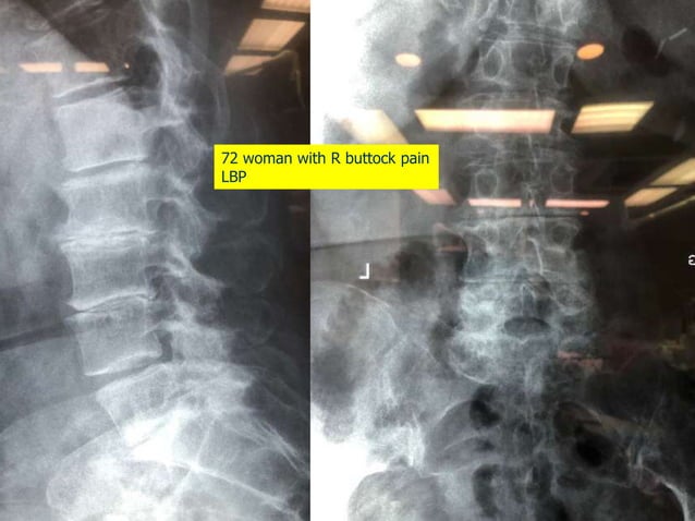 Spine Surgery Lecture ULBD | PPTX | Physical Therapy | Wellness