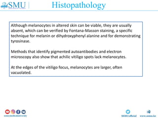 Lecture Vitiligo.pptx