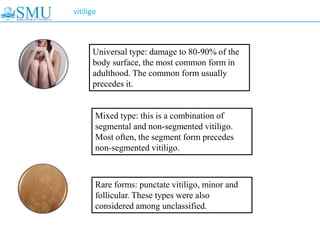 Lecture Vitiligo.pptx