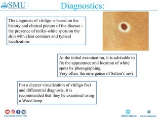 Lecture Vitiligo.pptx