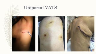 when to call a thoracic surgeon | PPT