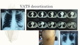 when to call a thoracic surgeon | PPT