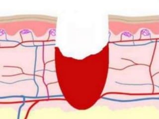 Wound Infection Animation