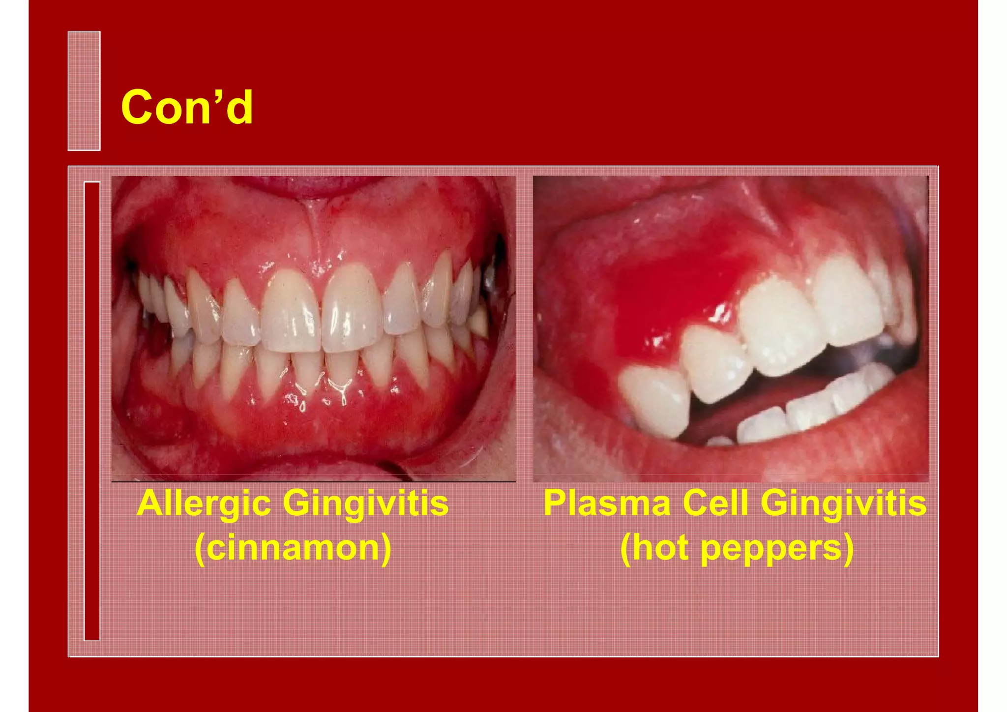 Lecture xiii ju-oral pathology-lecture xiii-perio5 | PDF