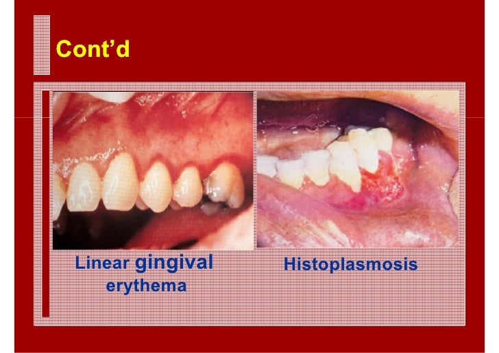 Lecture Xiii Ju Oral Pathology Lecture Xiii Perio5