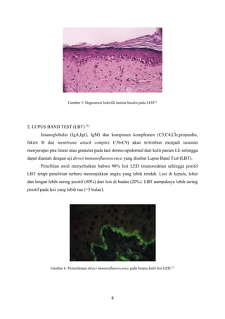 Lupus Eritematous Discoid | DOCX