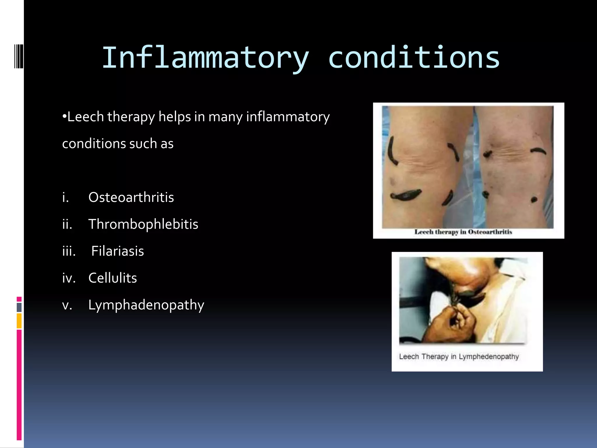 Irsal e Alaq (Leech Therapy) | PPTX