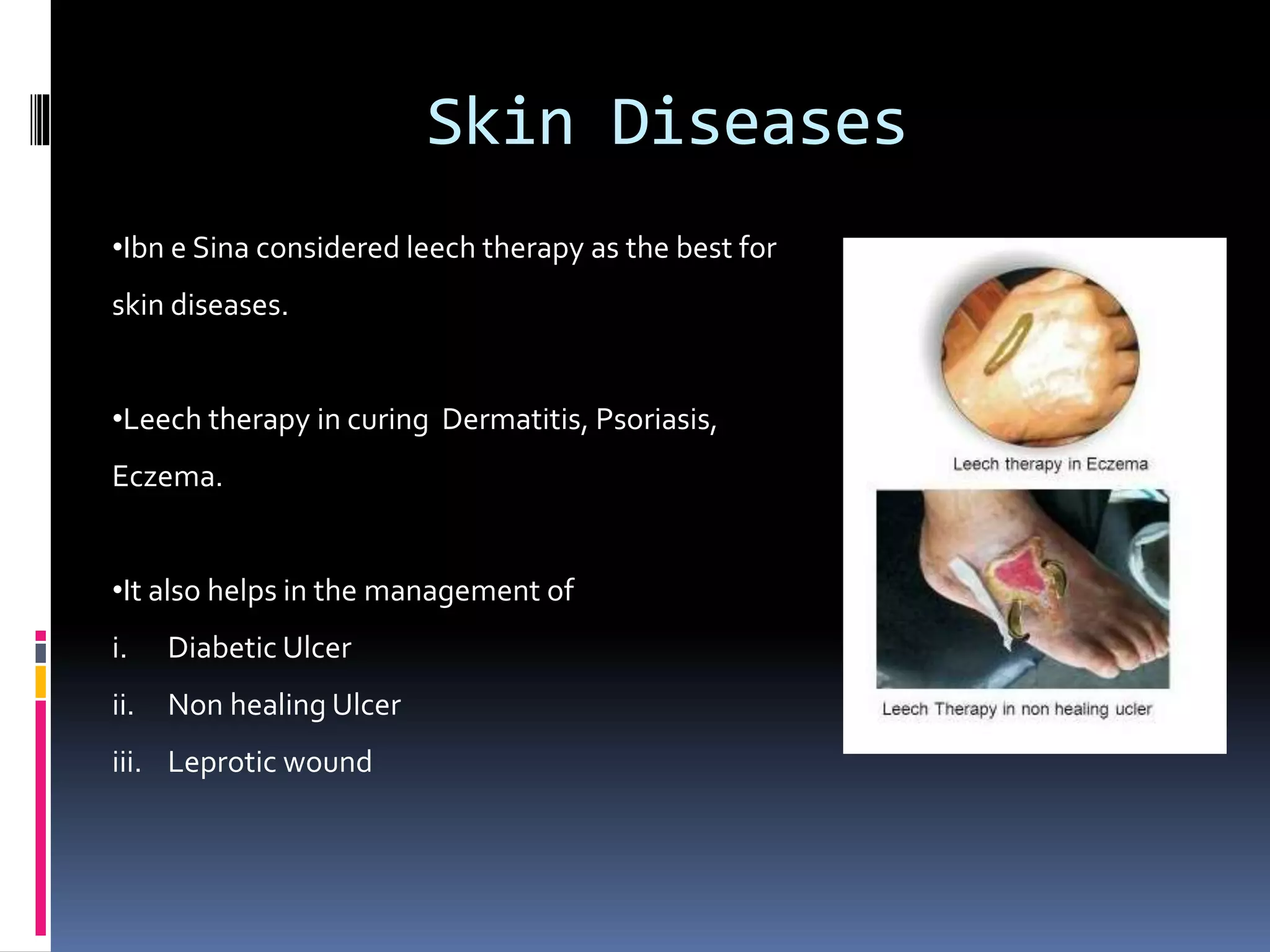 Irsal e Alaq (Leech Therapy) | PPTX