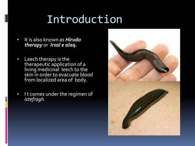 Irsal e Alaq (Leech Therapy) | PPT