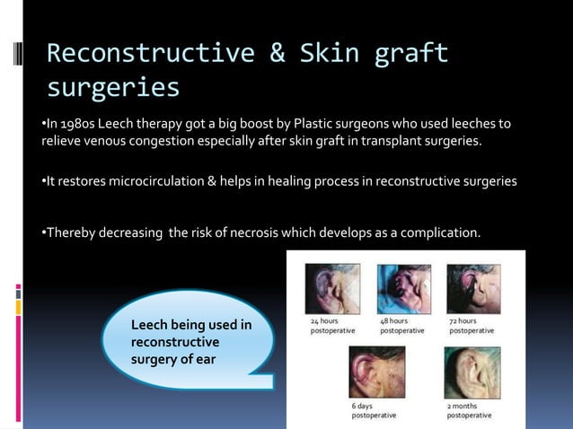 Irsal e Alaq (Leech Therapy) | PPT