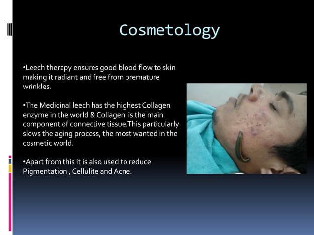 Irsal e Alaq (Leech Therapy) | PPT