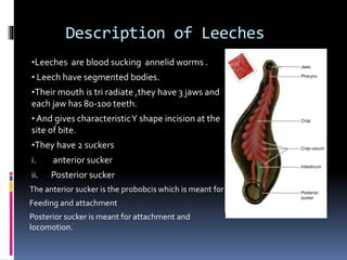 Irsal e Alaq (Leech Therapy) | PPTX