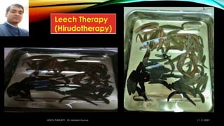 Leech therapy, Hirudotherapy, Jalaukavacharana, लीच थेरेपी | PPT