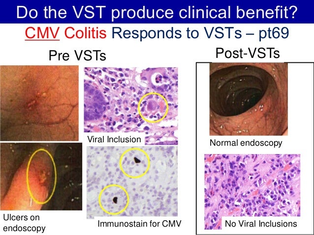 Multicenter Study of Third-Party Virus-Specific T cells to Treat Aden…