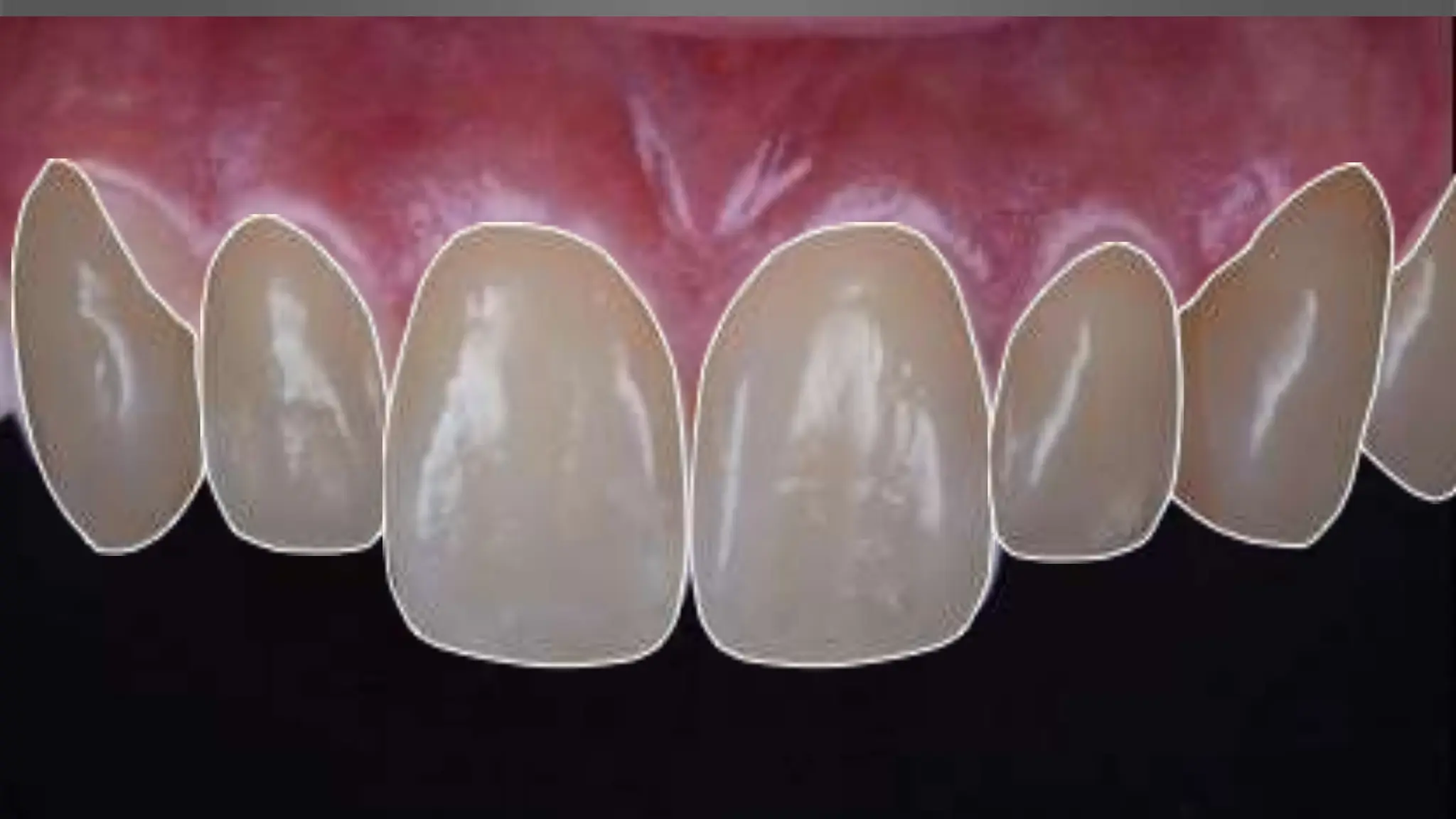 Esthetic case presentation digital smile analysis.pptx